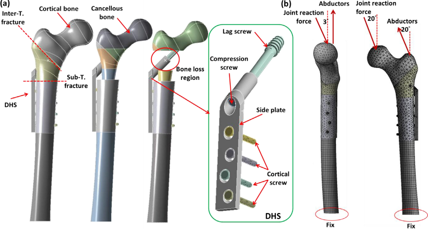 شکستگی فمور و جراحی به روش Dinamic hip screw DHS